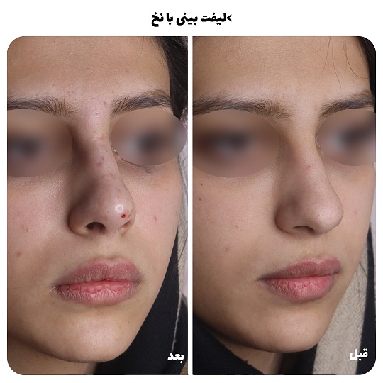 از بین بردن قوز بینی استخوانی - کلینیک بین المللی پوست مو و زیبایی الهیه